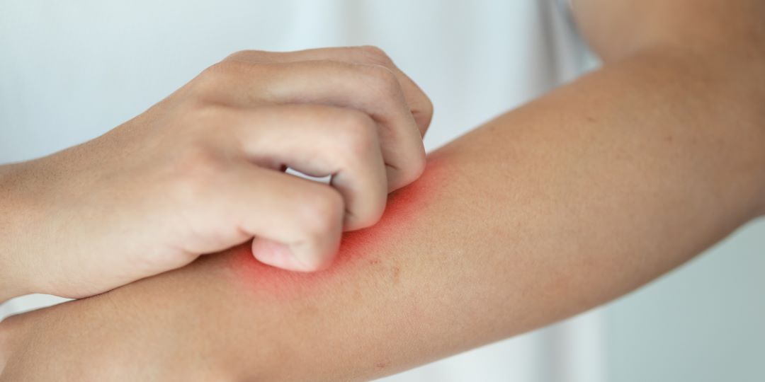 Tipos de Dermatite | Cuidamos Juntos