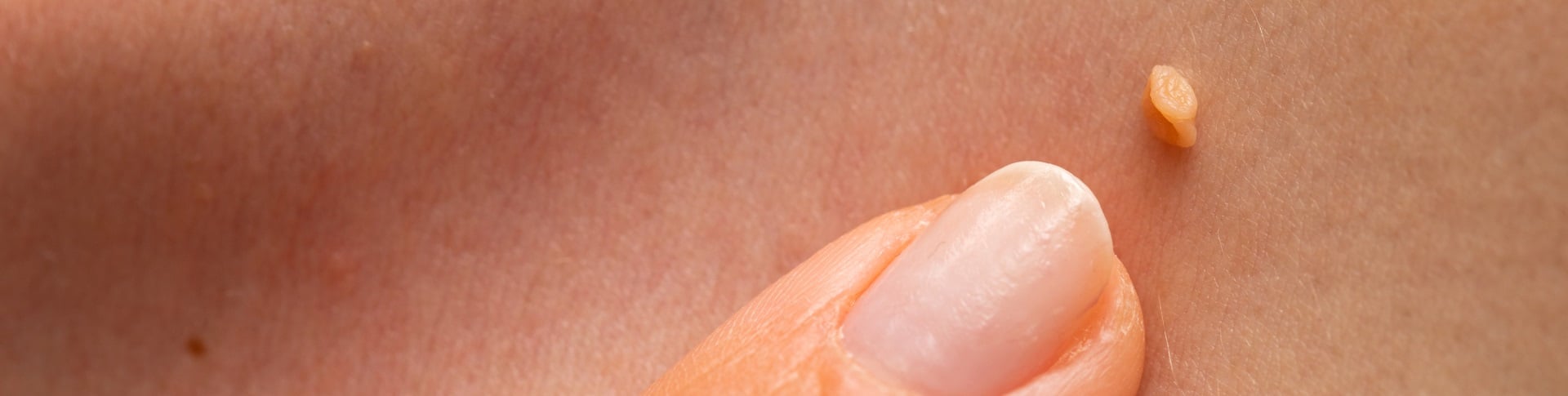 HPV: o que é, sintomas e prevenção